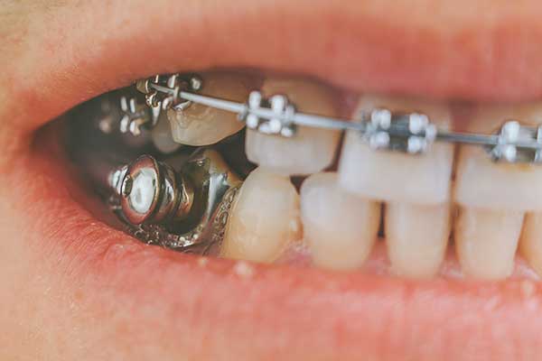 Early Orthodontic Treatment